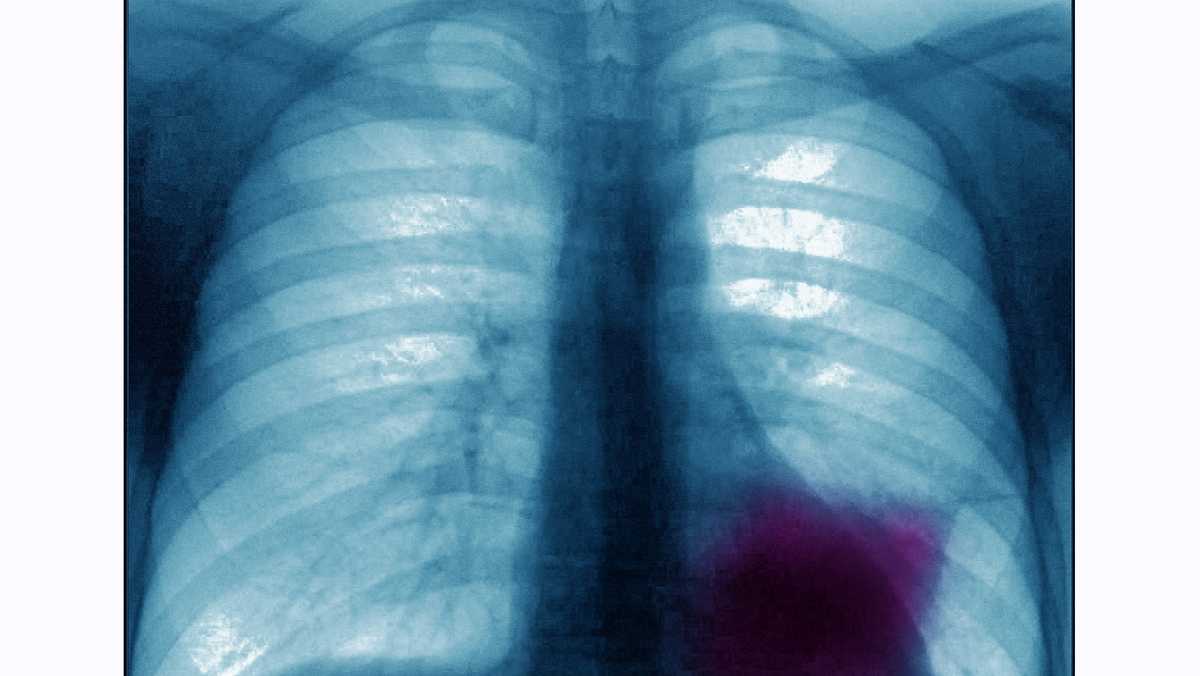 US cancer death rate sees largest-ever single-year drop, according to ...