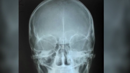 UCLA study finds head injuries can change the genes in your brain