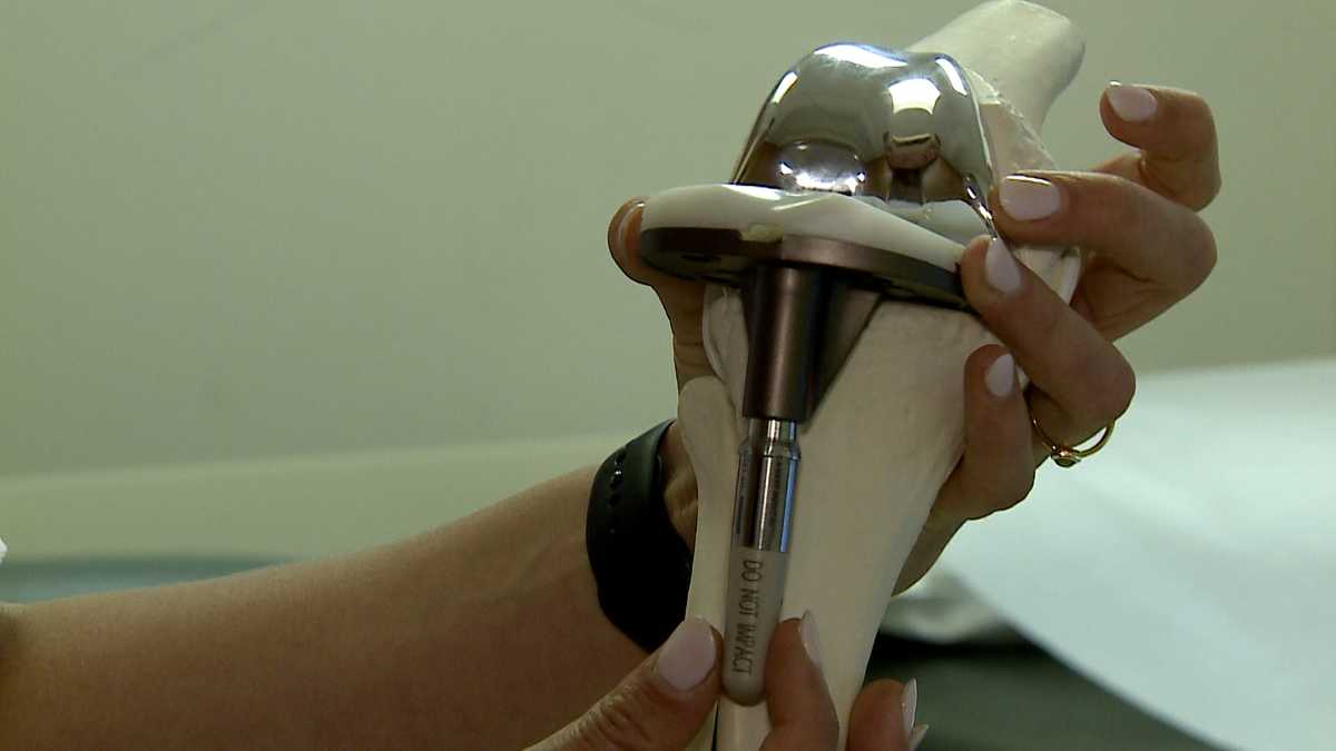 UofL Health using 'Smart Knees' to track post surgery progress