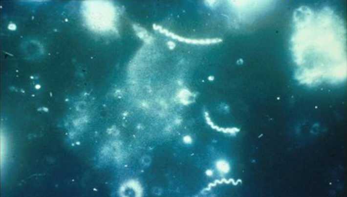 State agency aiding southwest Indiana county amid worsening syphilis ...