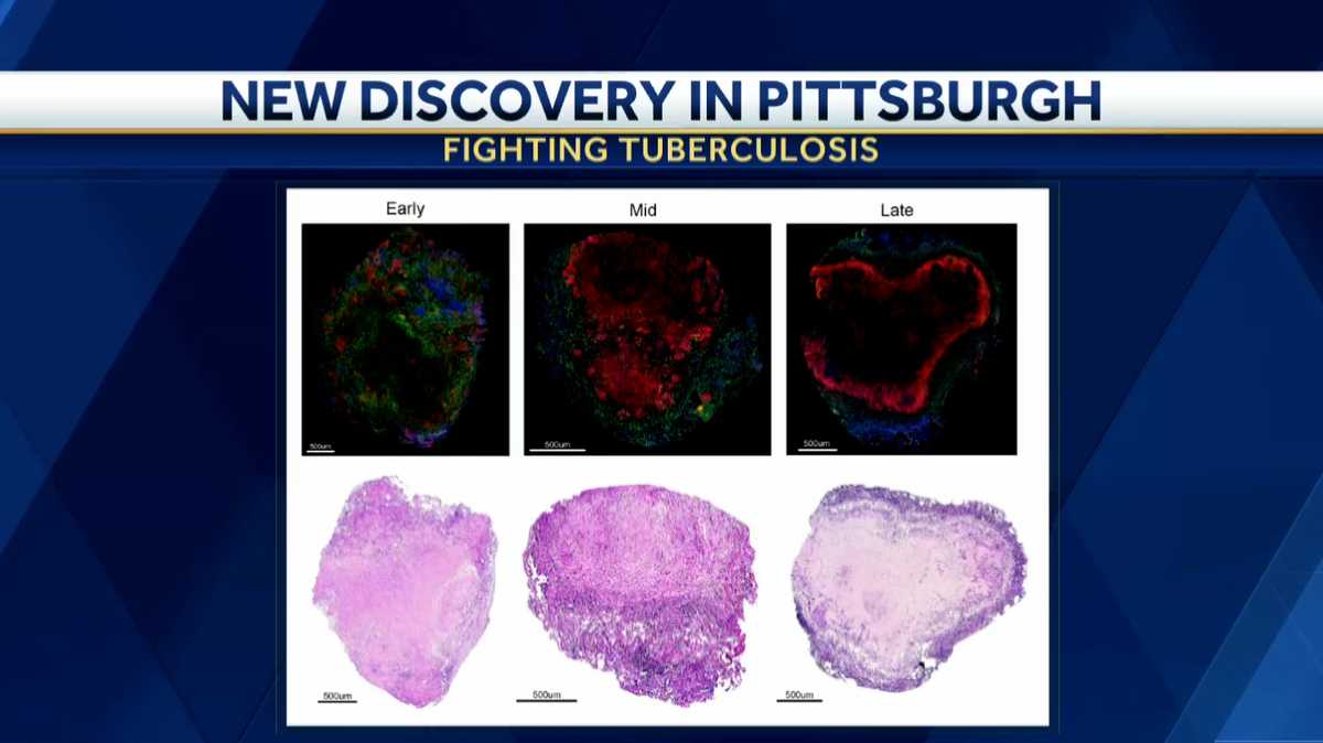 4 Your Health: New discovery in fight against tuberculosis