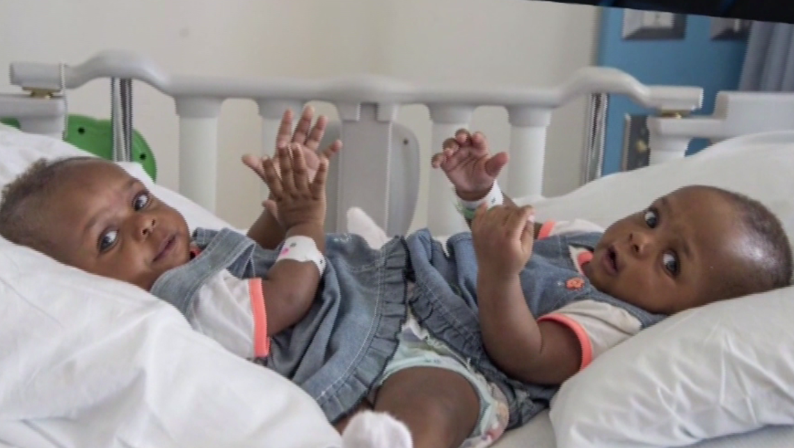 Conjoined twins separated with surgery