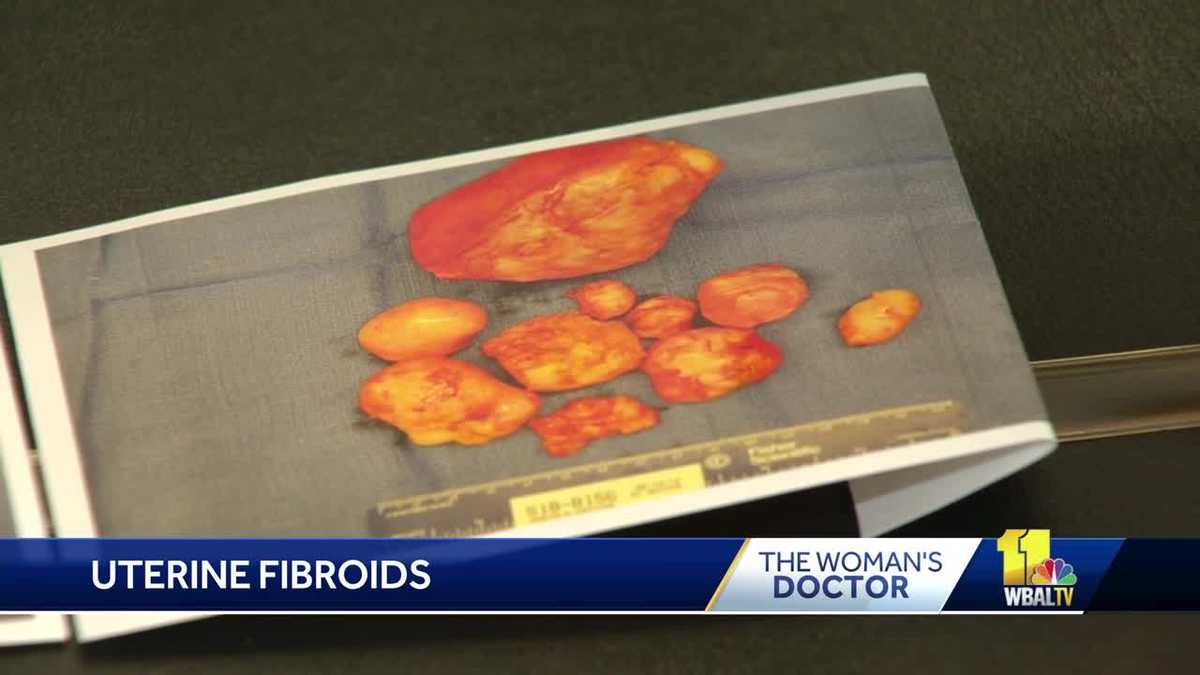 Woman's Doctor: 80% of women develop uterine fibroids