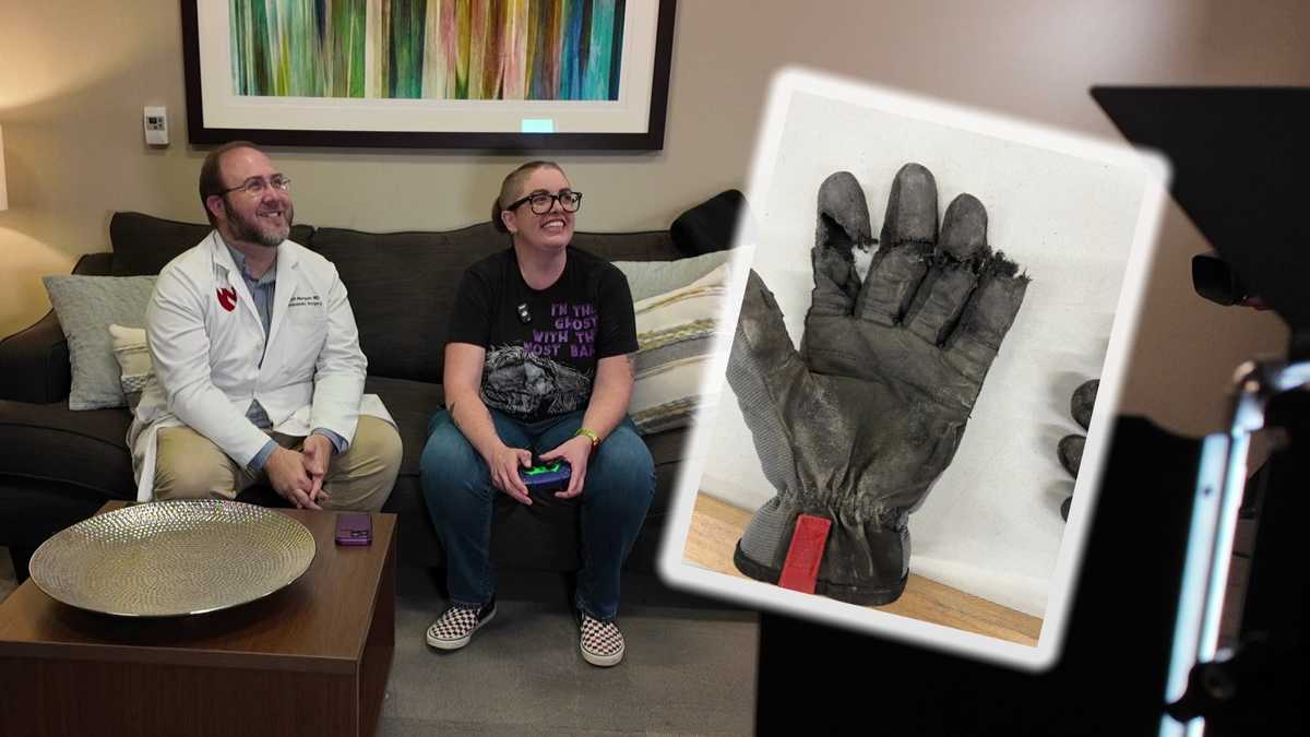 Fingers nearly amputated, saved by unique procedure at Nebraska Medicine