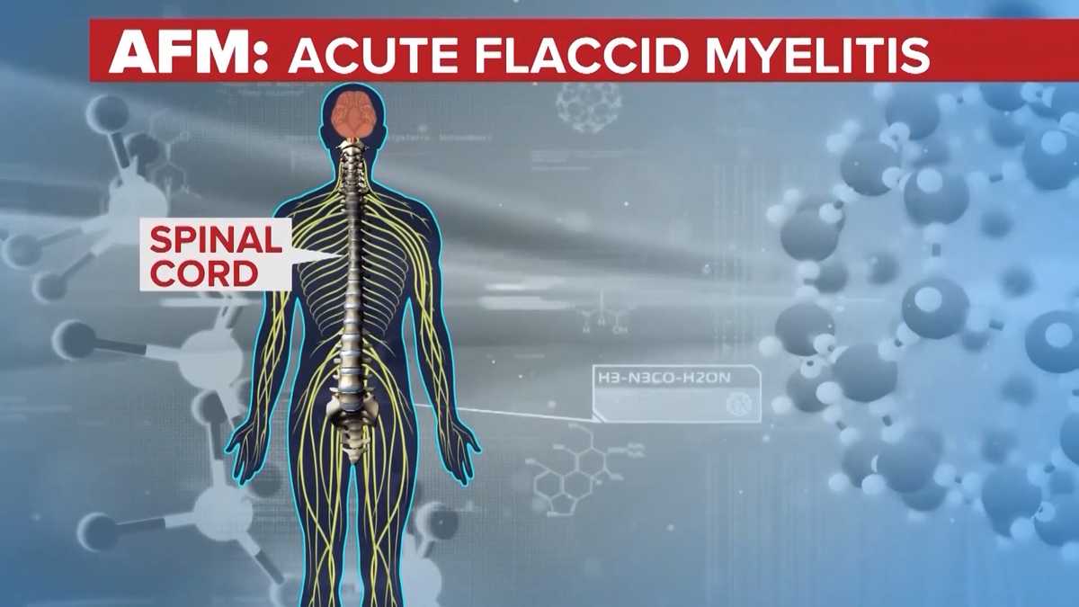 Iowa health officials confirm second case of rare nervous system disorder