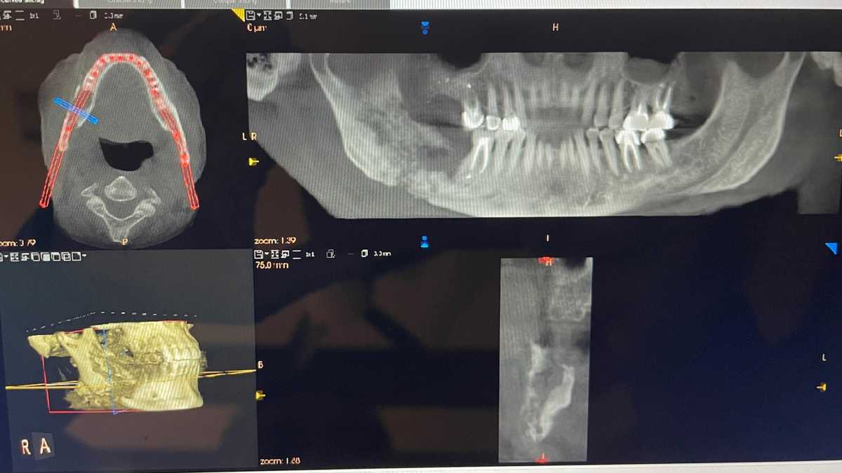 Florida cancer survivor's jaw reconstructed using his leg Florida cancer survivor's jaw reconstructed using his leg