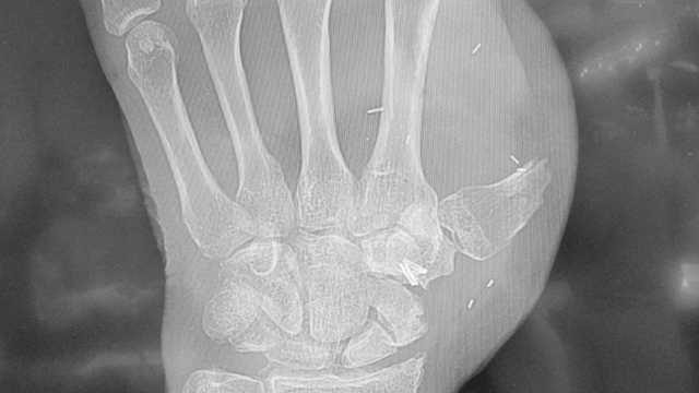 Toe, knee bones used in first-ever double-flap hand surgery