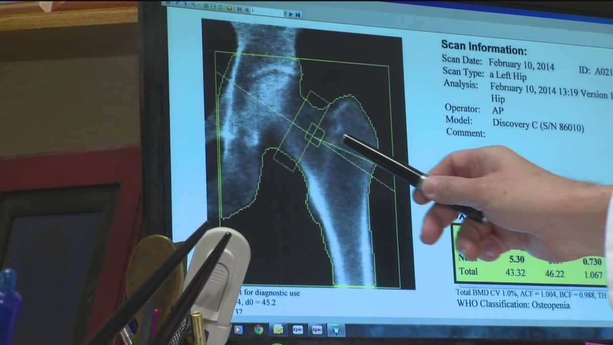 Bone density issues among women | Woman's Doctor