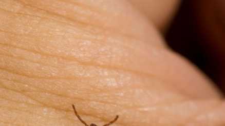 Tick bite puts Cape Cod man in coma with swollen brain