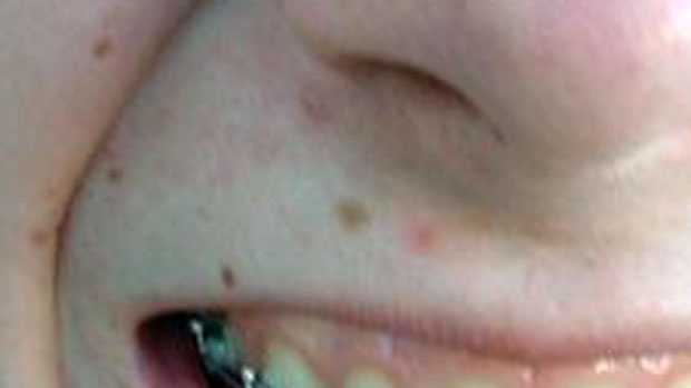 Dentists report spike in people trying DIY braces