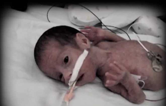 Miracle child Mitchell Pollock graduates high school after overcoming ...