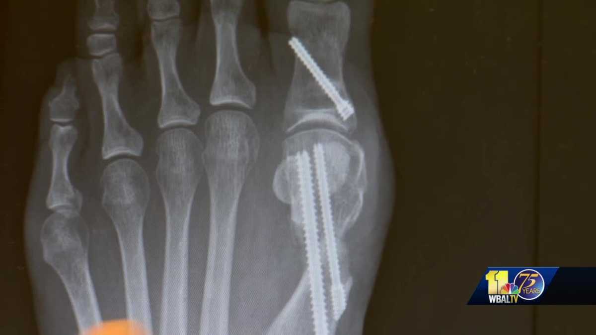 The Woman's Doctor: Treatment options for bunions