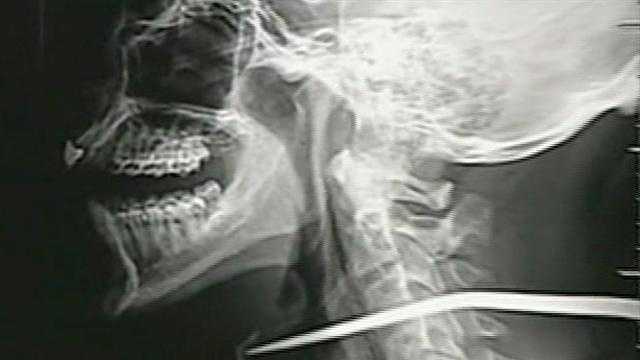 Correction Officer Survives Stabbing through his neck