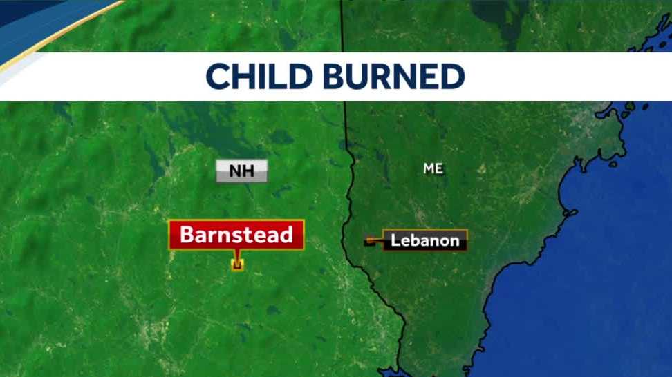 Boy with burns on face, arms flown to Boston for treatment