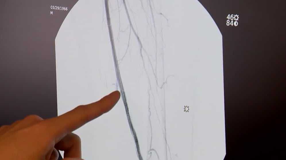 Diagnosing peripheral artery disease or PAD