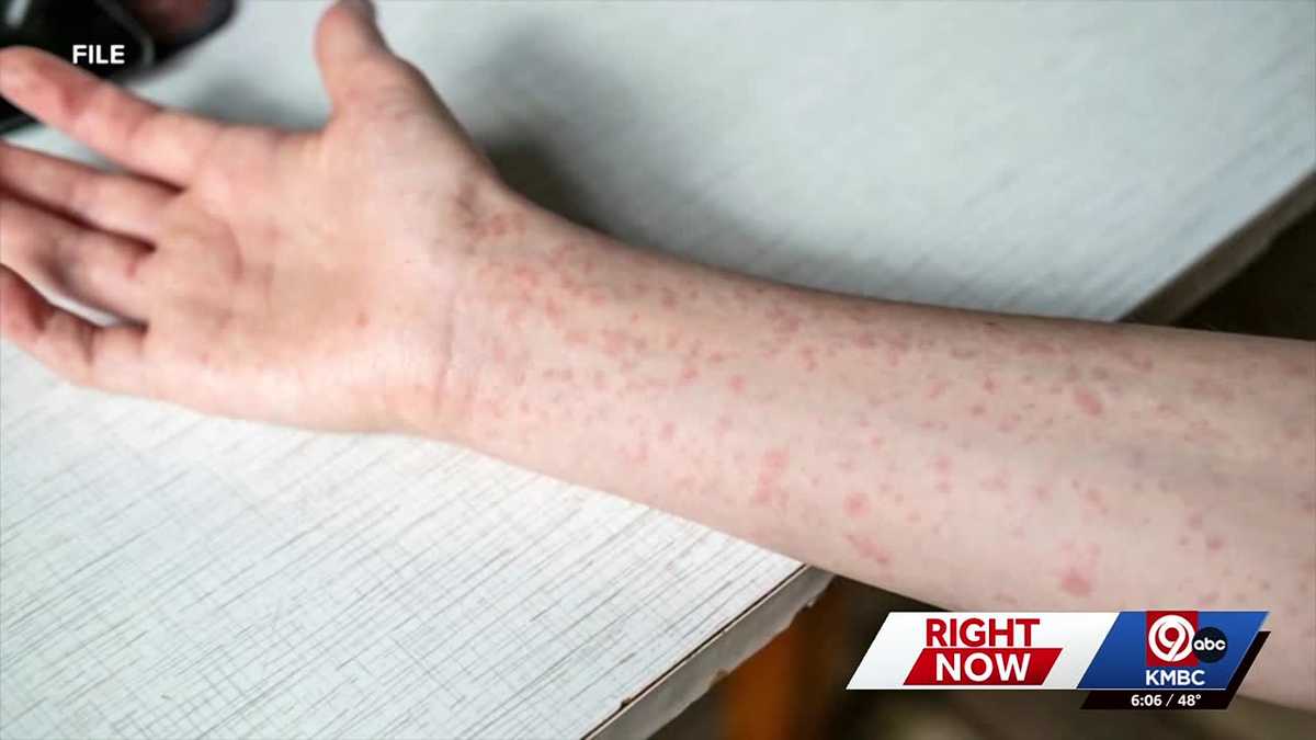 First measles case reported in Kansas City in years