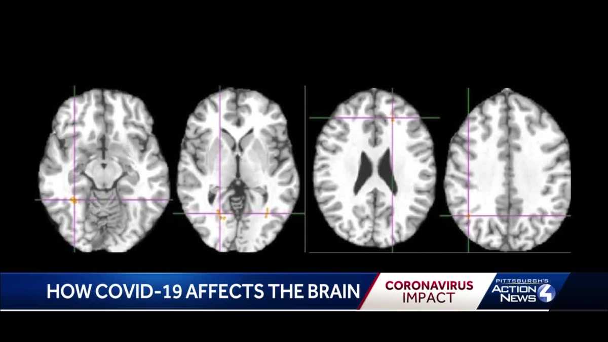 Pittsburgh doctor leading study to see how COVID-19 affects the brain