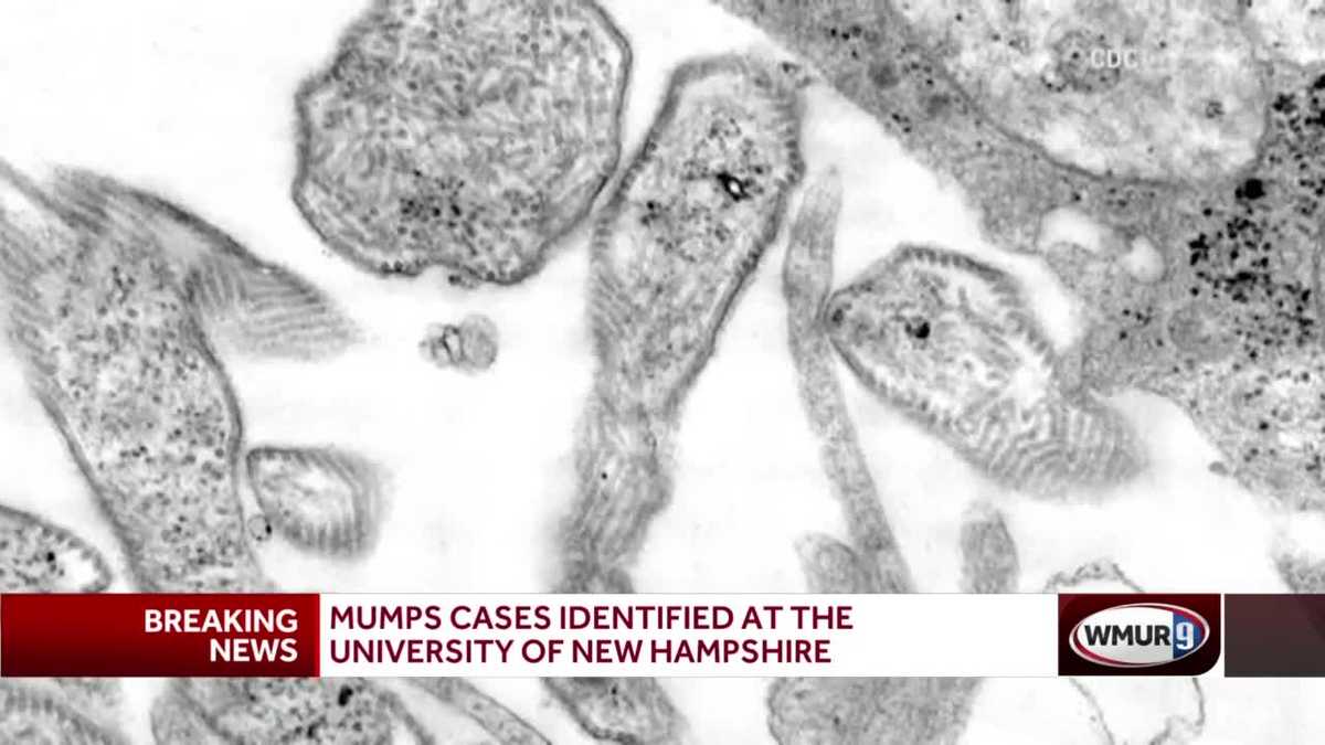Mumps cases identified at UNH