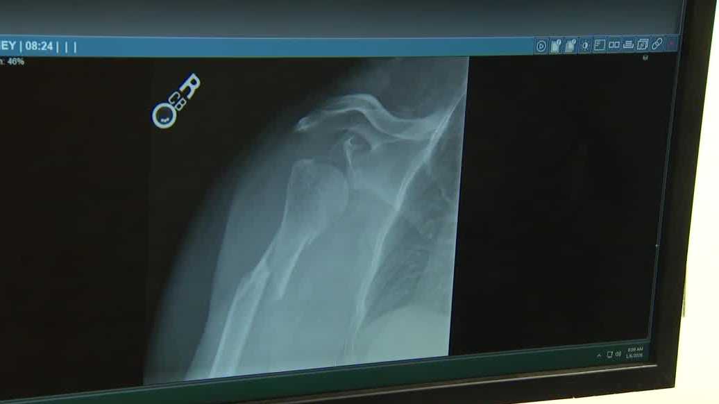 Woman's Doctor: Shoulder injuries become more common as women age