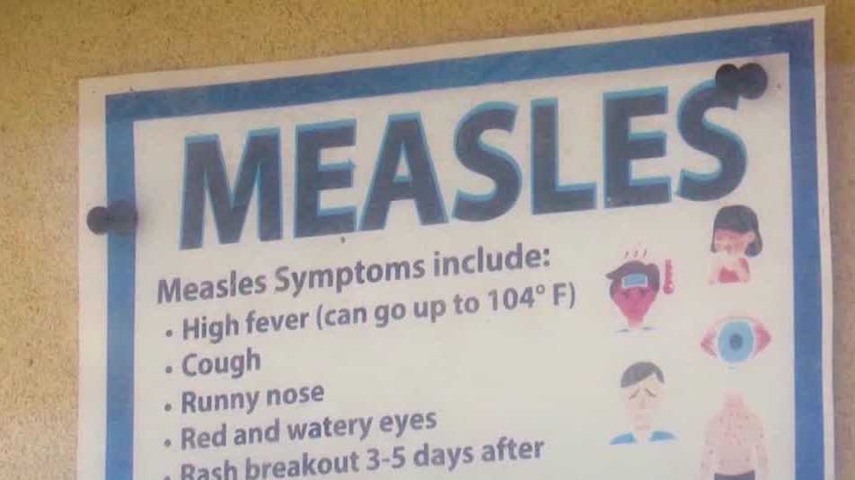 Measles case confirmed in South Florida