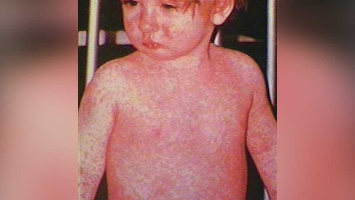 Highly contagious, easily catchable disease making comeback