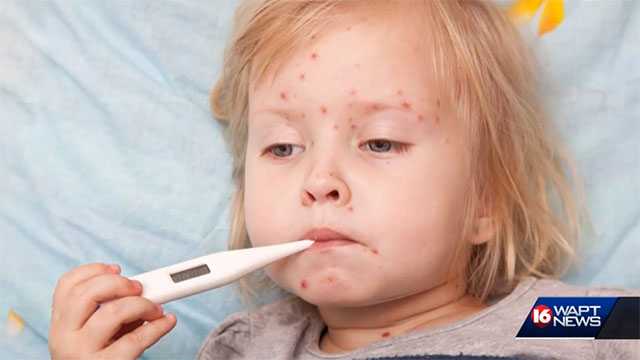 ‘Chickenpox parties’ not the way to go, doctor says