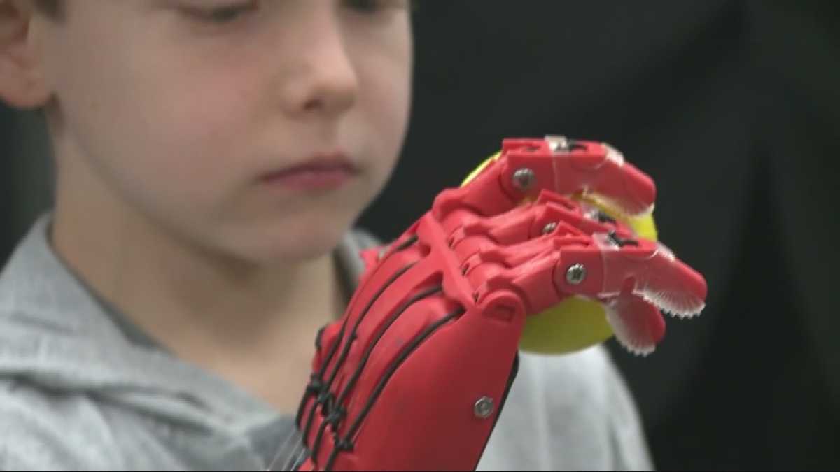 3D printer changing life of boy born without fingers