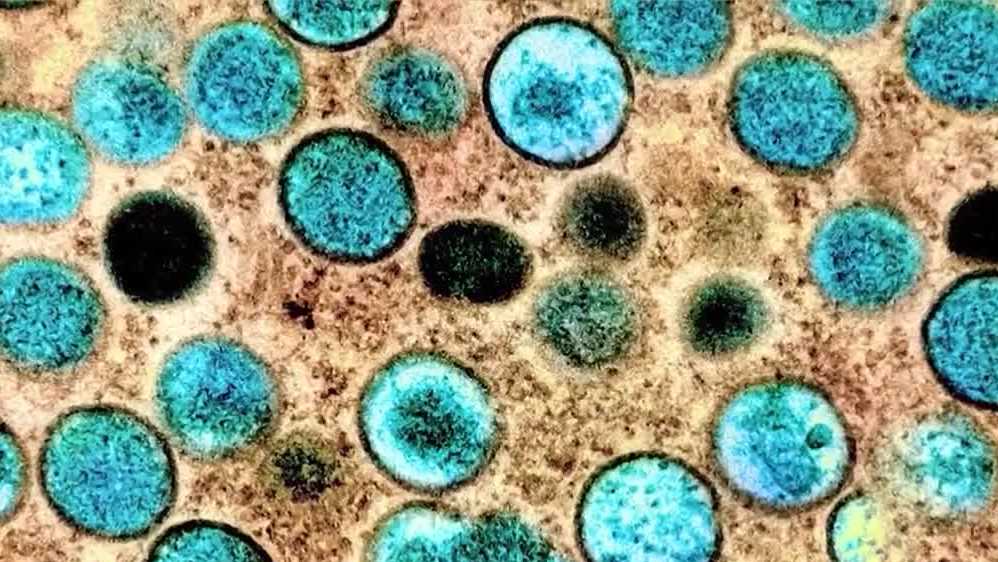 NH resident diagnosed with clade I mpox