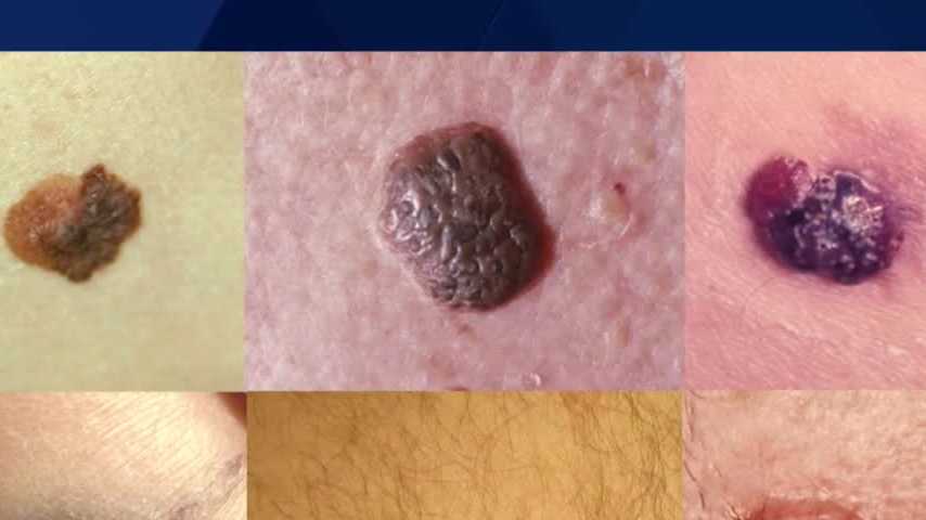 Many New Englanders at increased risk for deadly skin cancer, Brigham ...