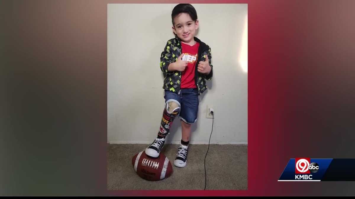 KCK boy gets Chiefs-decorated prosthetic leg