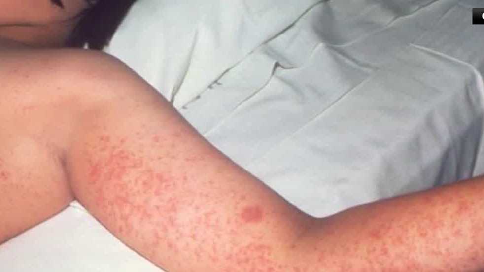Measles in Iowa: New case sparks concerns over travel, child care