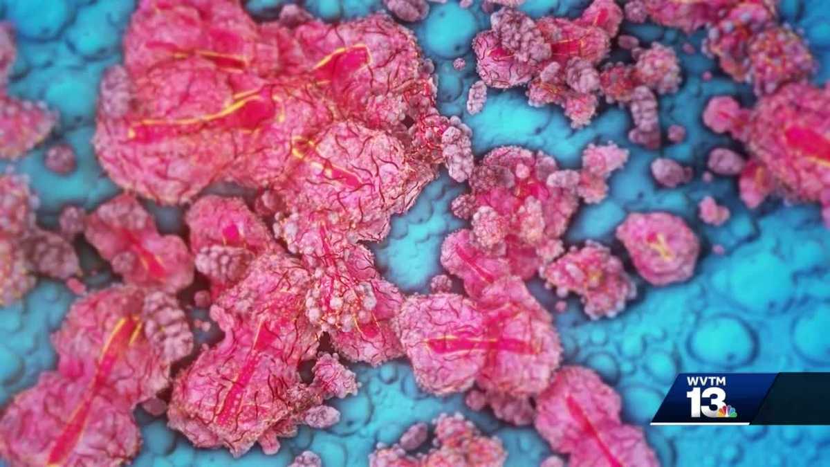 Infectious disease expert explains monkeypox virus, LGBTQ+ stigma