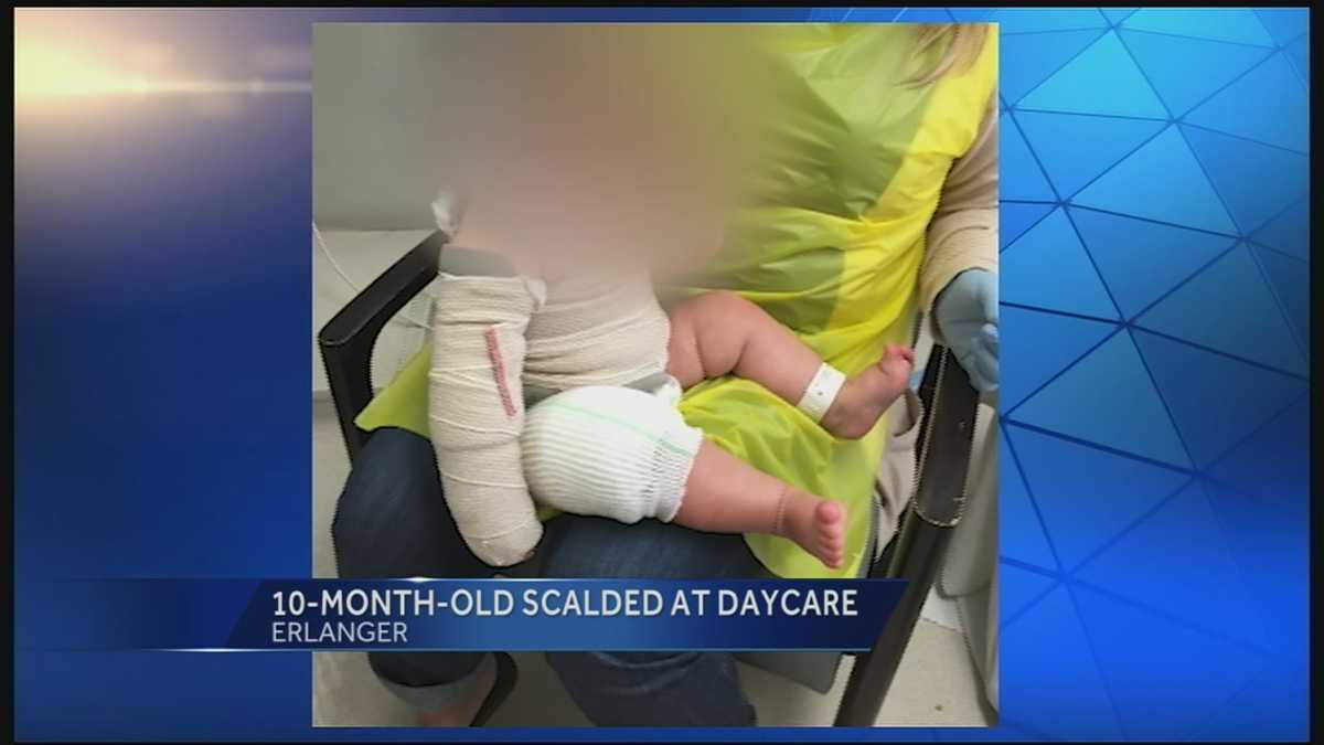 10-month-old boy scalded at Cornerstone Child Development Center