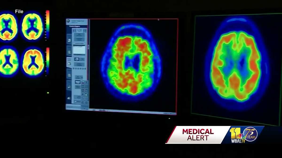 Medical Alert: Diagnosing Alzheimer's