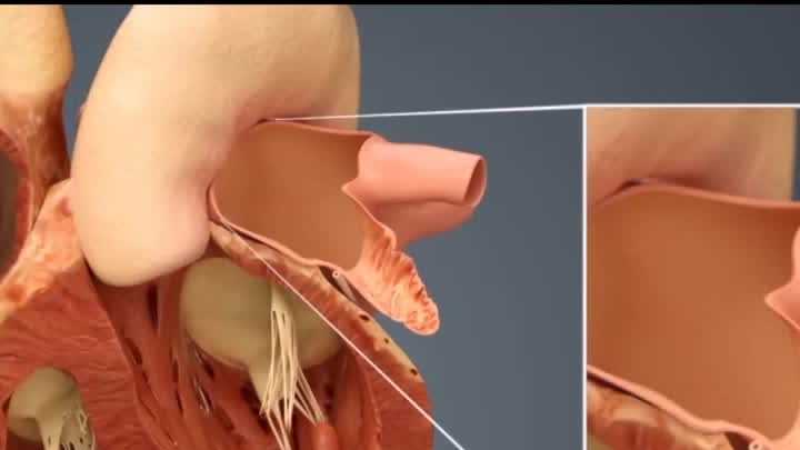 Project Heart Start: WATCHMAN procedure helping patients