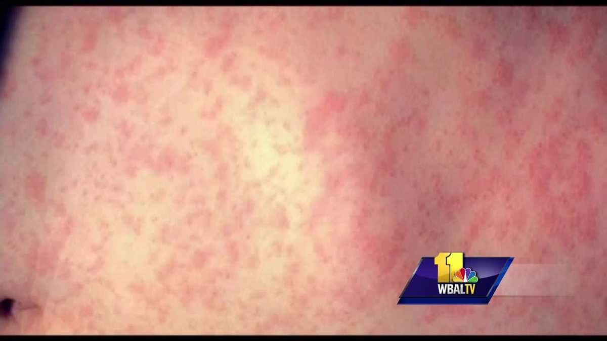 Video: Watch out for the mumps!