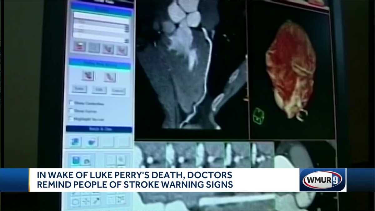 In wake of Luke Perry's death, doctors warn of signs of stroke