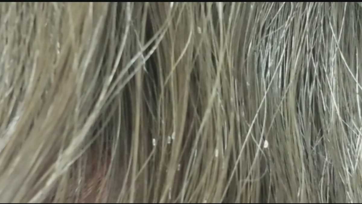 South Carolina sorority, bridal party selfies lead to lice infestations