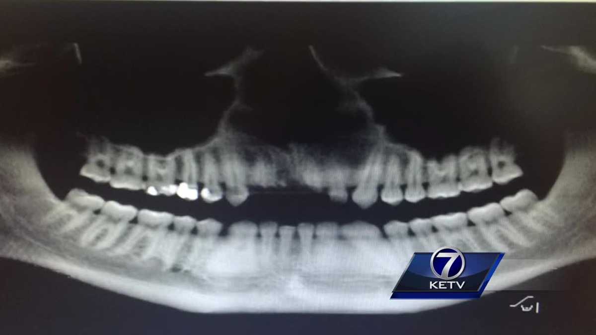 Vaporizer explodes in man's mouth