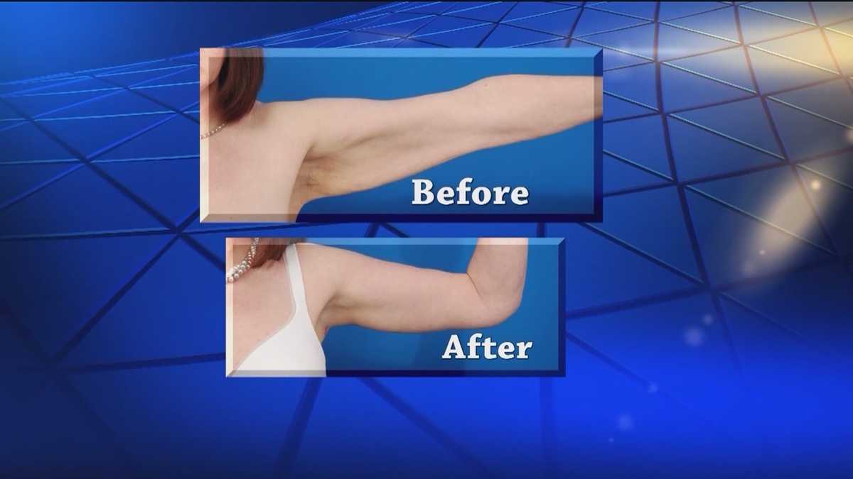 Procedure removes excess skin from upper arm