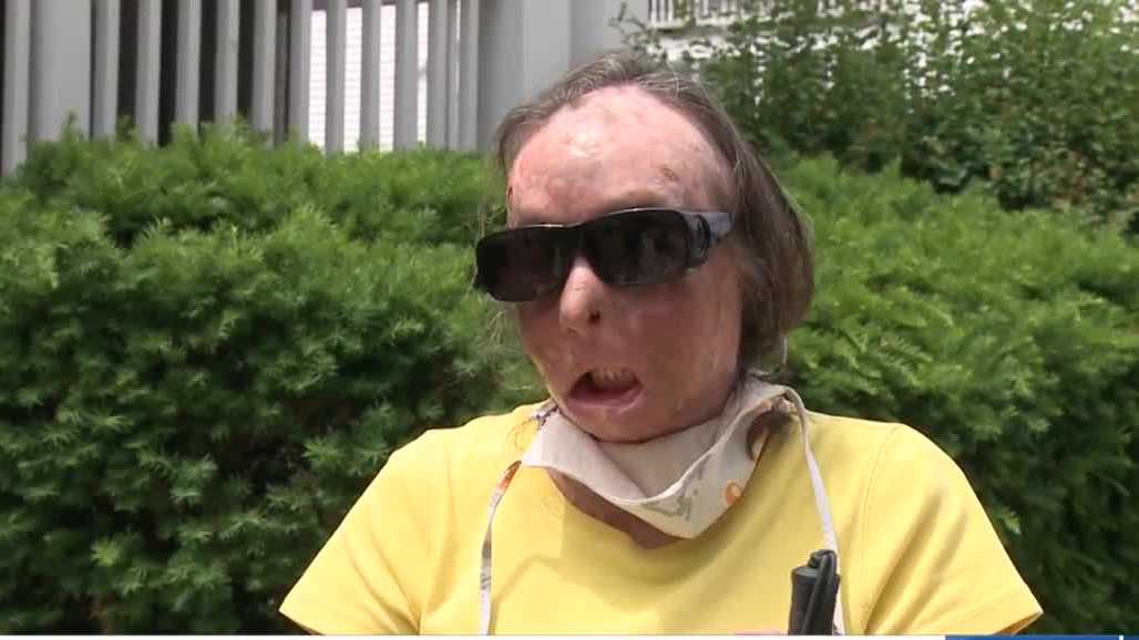Woman Becomes 1st Person In Us To Receive A 2nd Face Transplant
