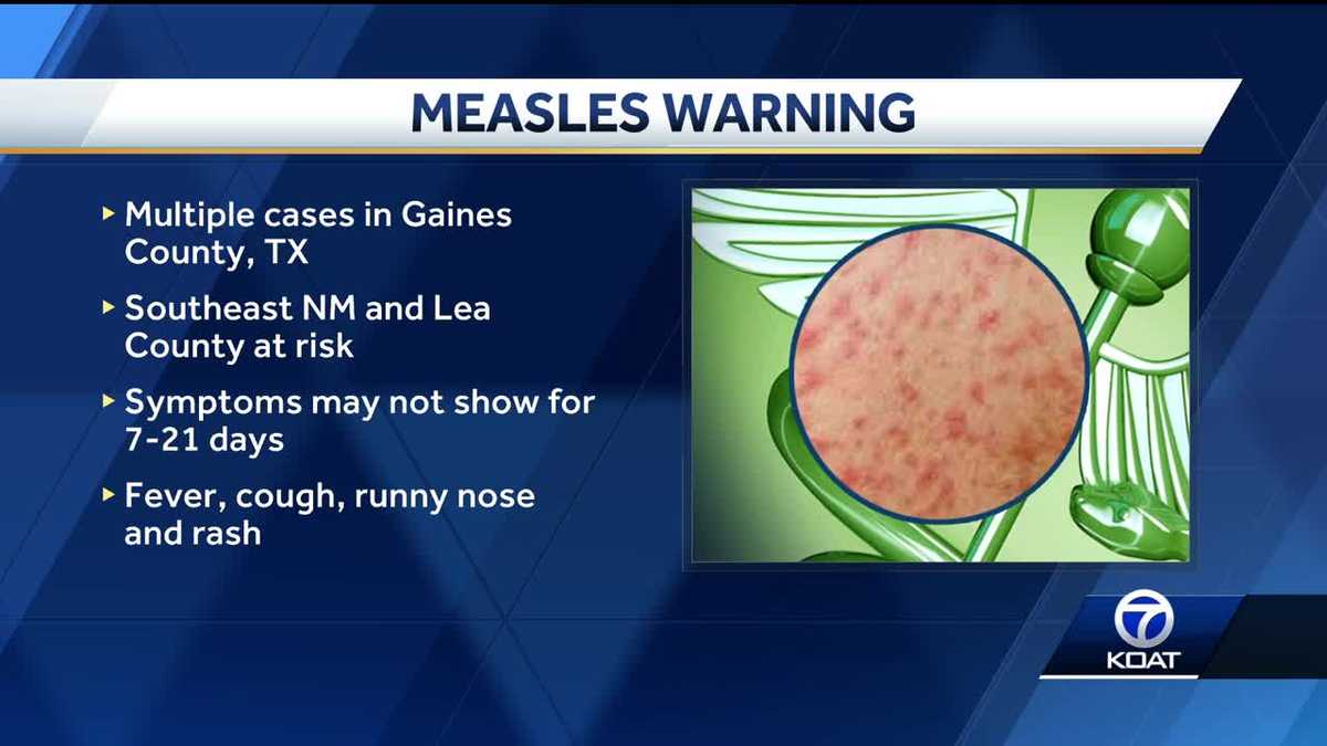 New Mexico health officials warn of potential measles threat