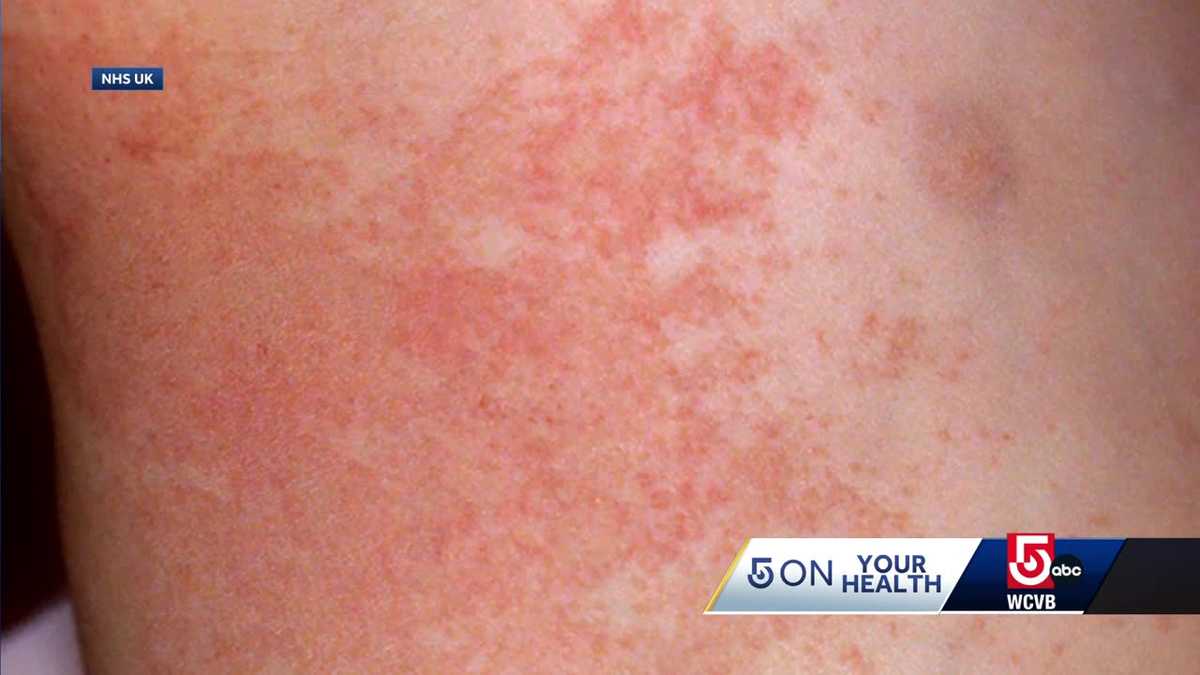 Treating those hot weather skin rashes and when to worry