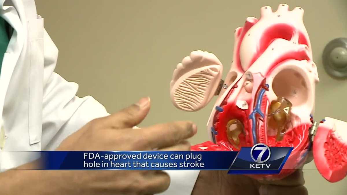 FDA-approved device can plug hole in heart that causes stroke