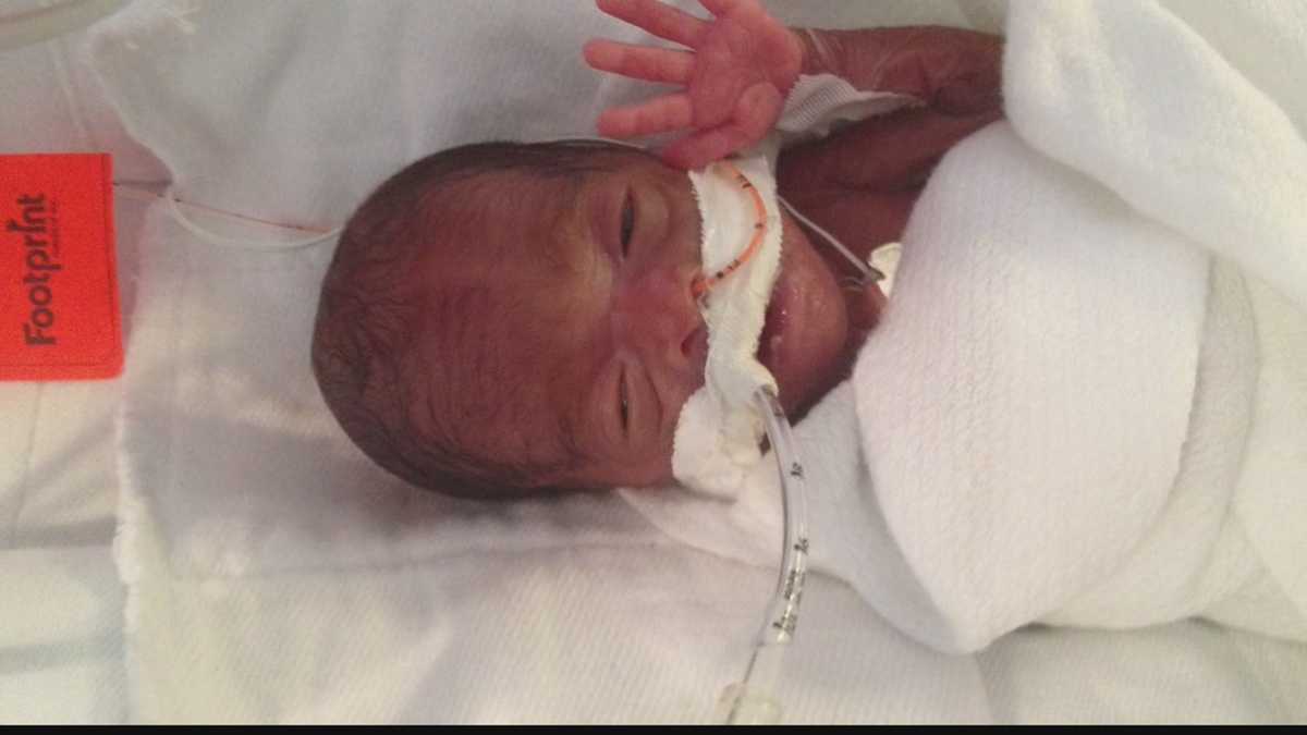 Doctor who delivered 13-ounce baby calls it 'amazing'