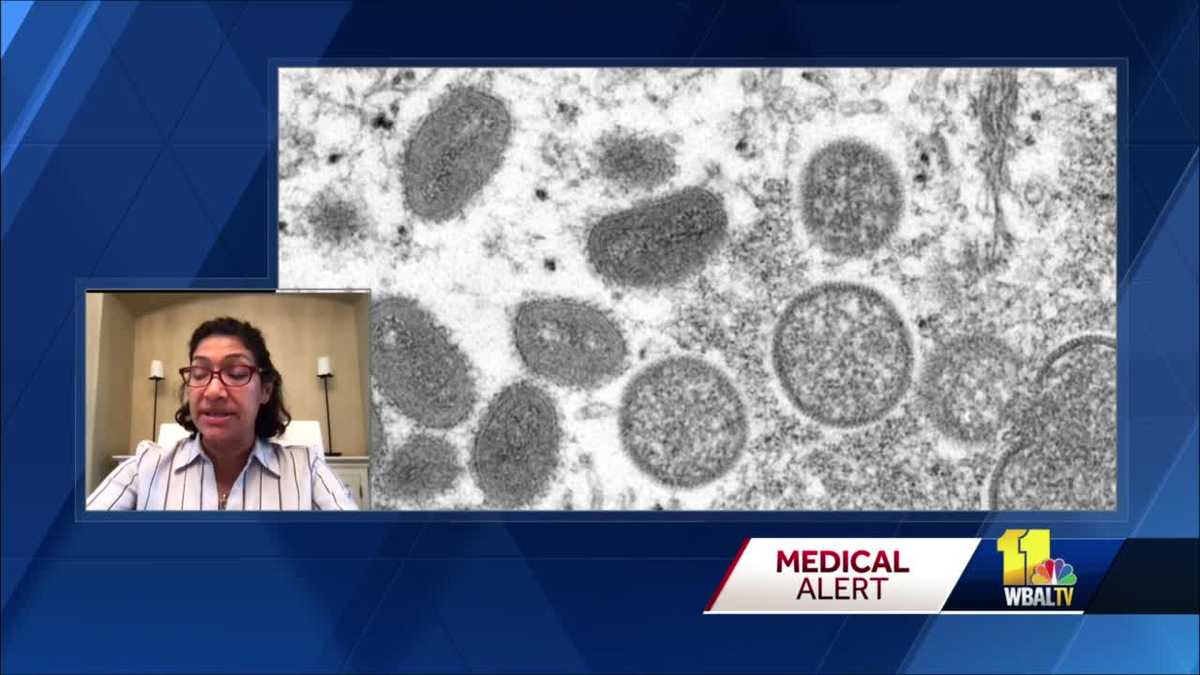 Medical Alert: Monkeypox spreading, even here in Maryland