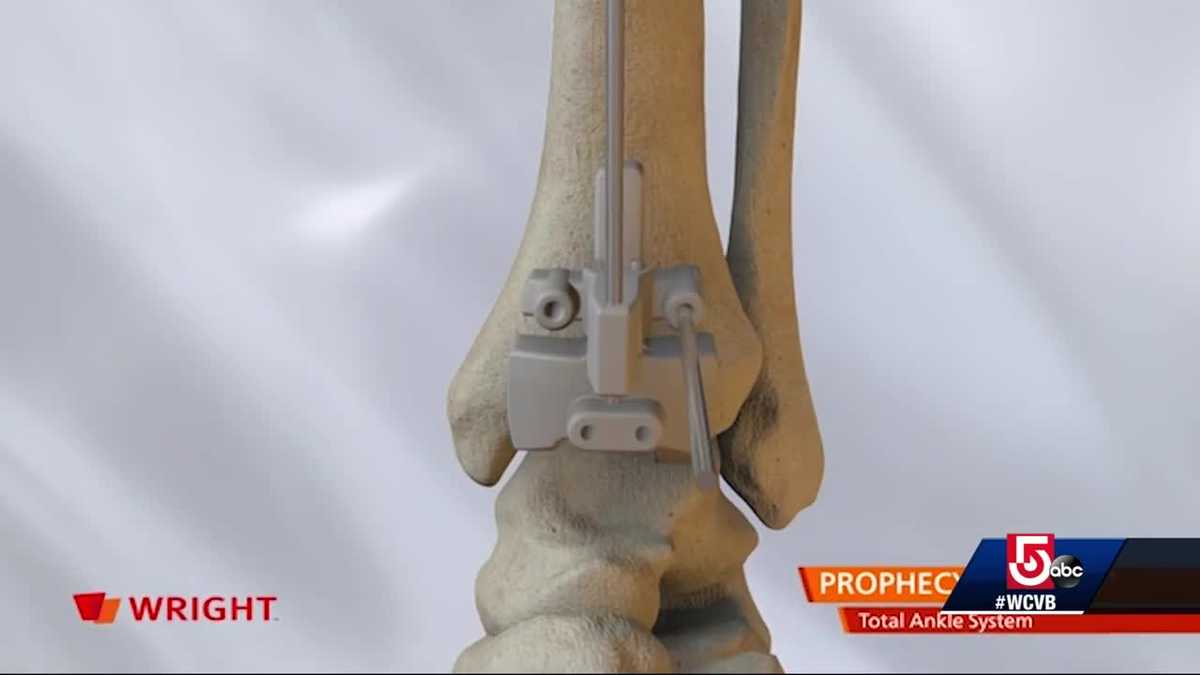 Total ankle replacement surgery offers pain relief for patients