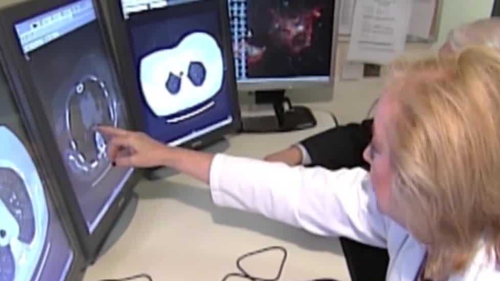Lung Cancer Survival Rates Rise But Its Still The Leading Cause Of Cancer Death