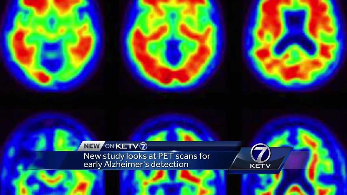 New study looks at PET scans for early Alzheimer's detection