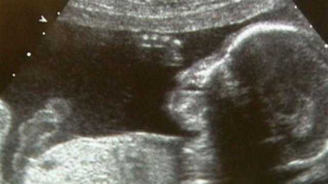 Earlier, Easier Down Syndrome Test